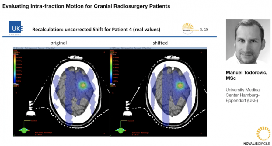 Evaluating Intra-fraction motion for cranial radiosurgery patients