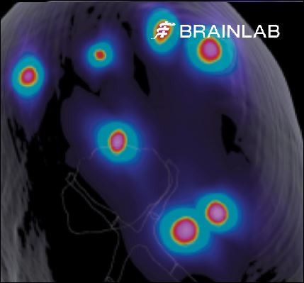 SRS & SBRT – Insights from a Neurosurgeon