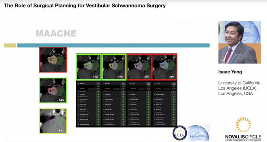 The Role of Surgical Planning for Vestibular Schwannoma Surgery