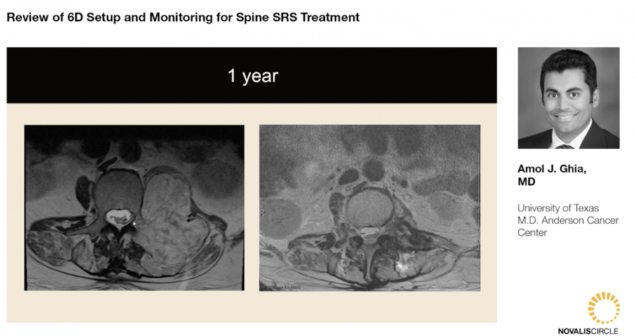 Review of 6D Setup and Monitoring for Spine SRS Treatment